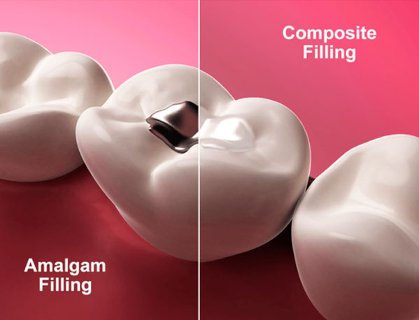DENTAL FILLINGS: AMALGAM VS. COMPOSITE - #1 Dental Office in California ...